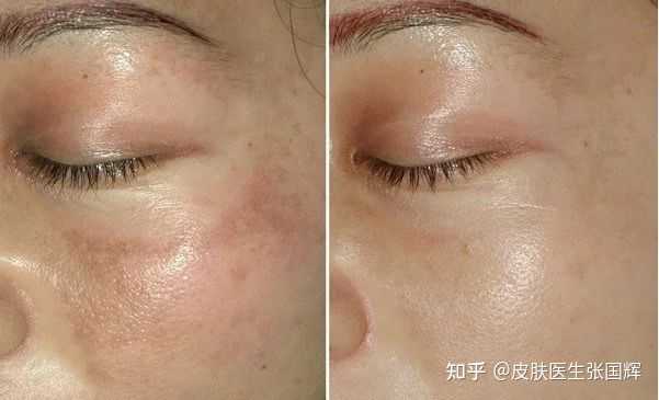 治疗黄褐斑用氢醌乳膏副作用大么? - 知乎