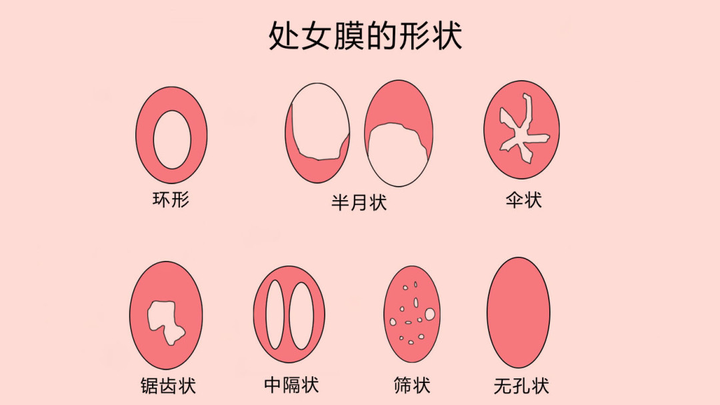 关于处女膜的形态,你知道多少? 知乎